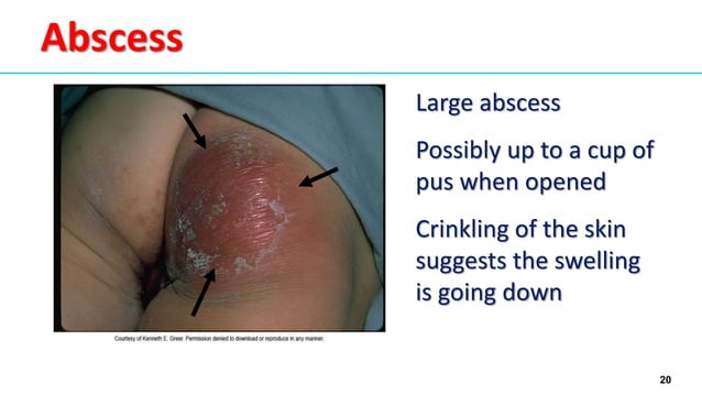 04. cellulitis.ppt | Ear, Nose and Throat Conditions | Diseases and Conditions