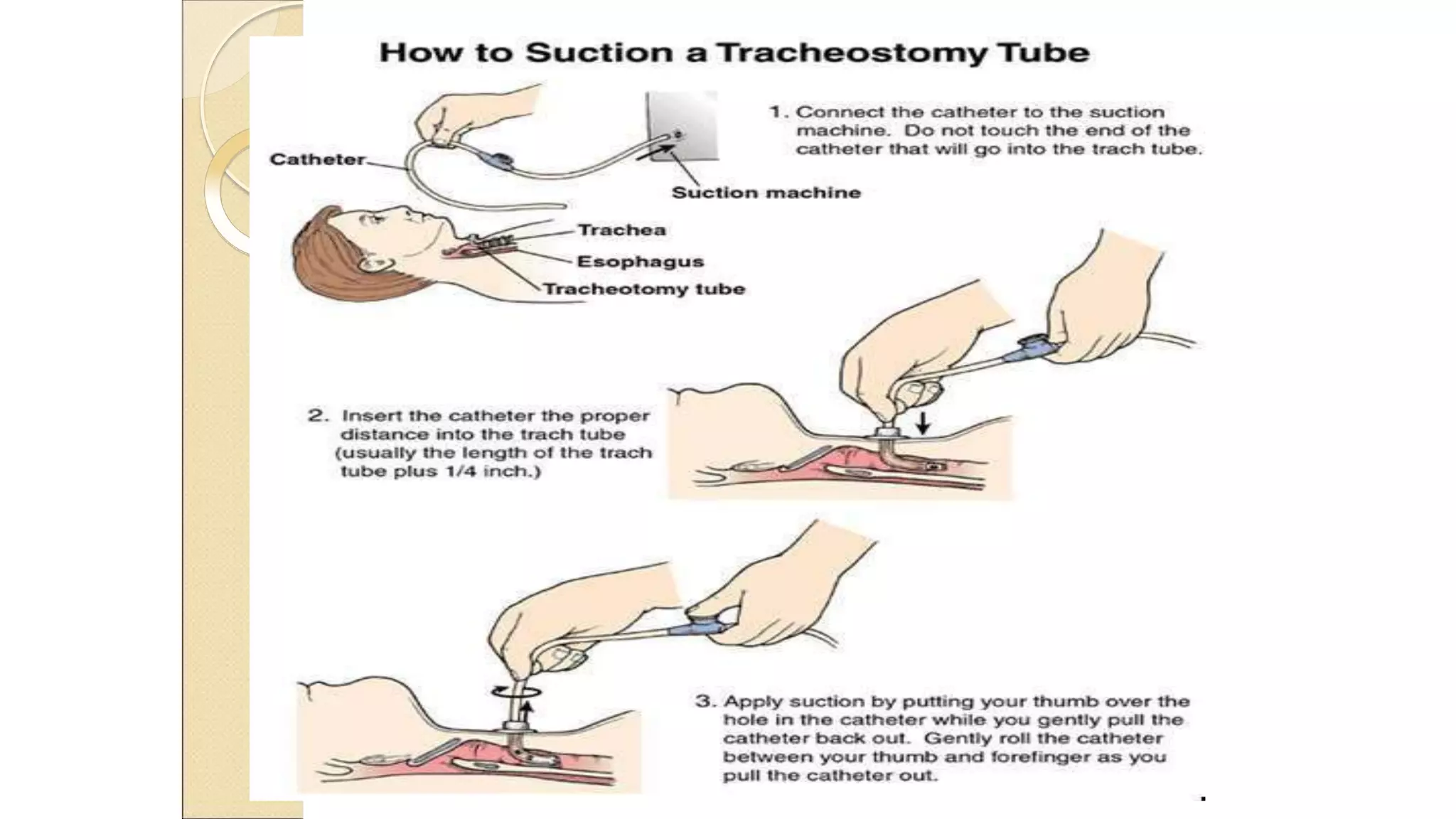 04. Tracheostomy.pptx