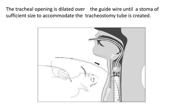 04. Tracheostomy.pptx