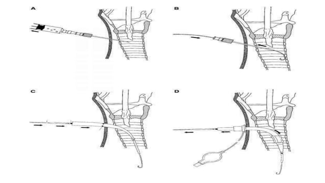 04. Tracheostomy.pptx