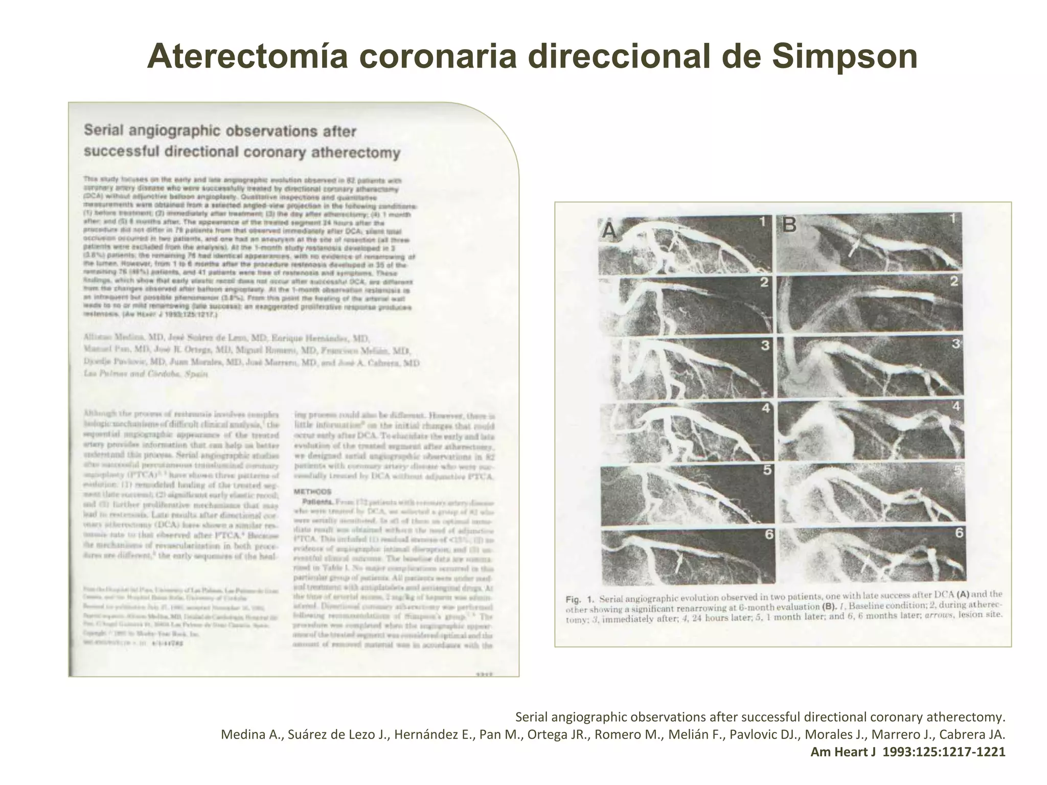 Aportaciones del grupo CORPAL en intervencionismo coronario | PDF