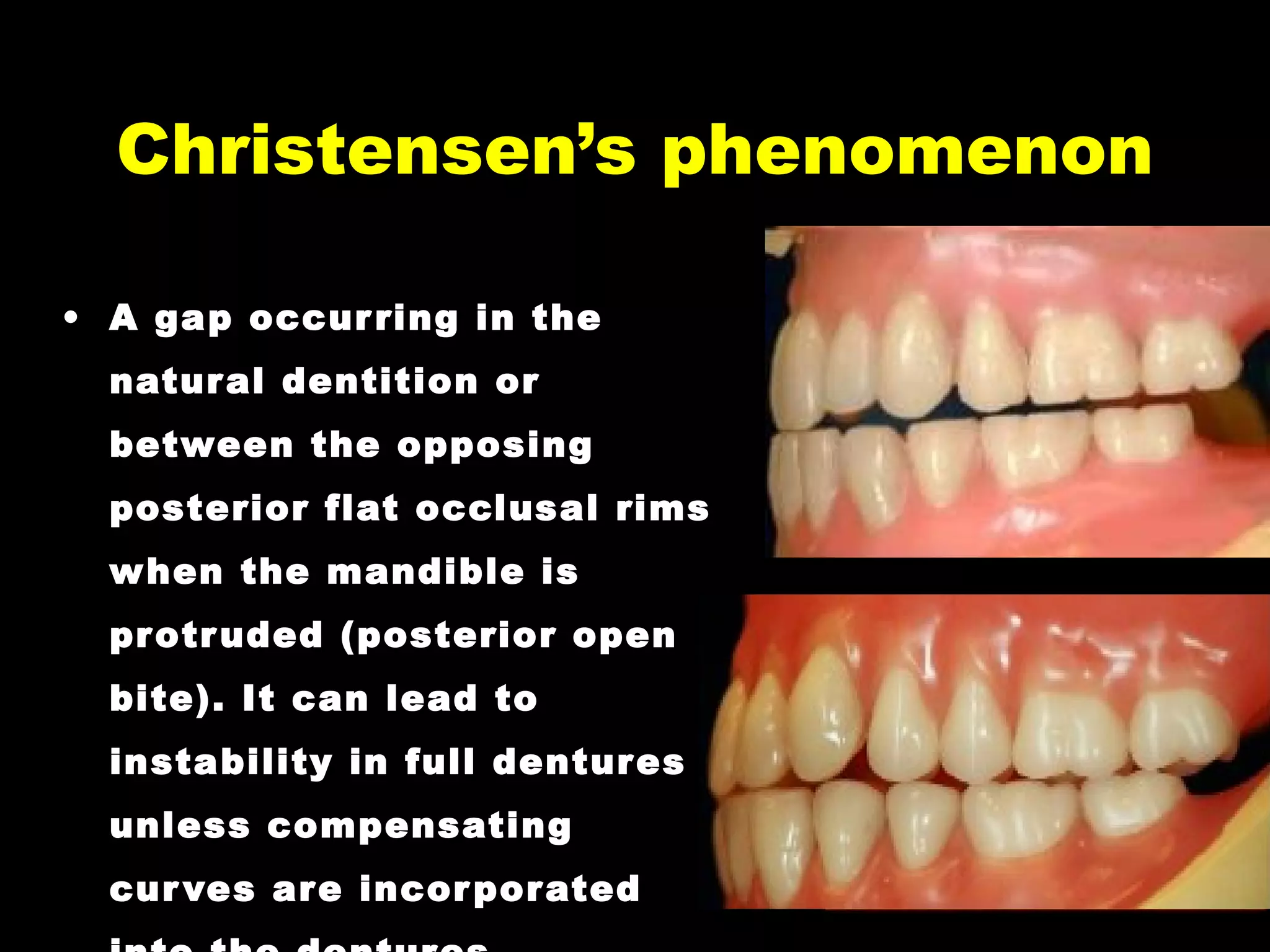 Concepts of Complete denture occlusion | PPT