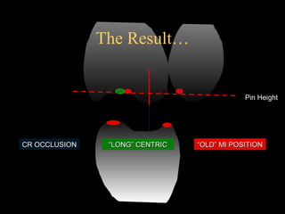 Concepts of Complete denture occlusion | PPT
