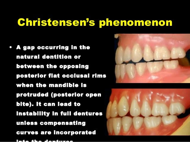 Concepts of Complete denture occlusion