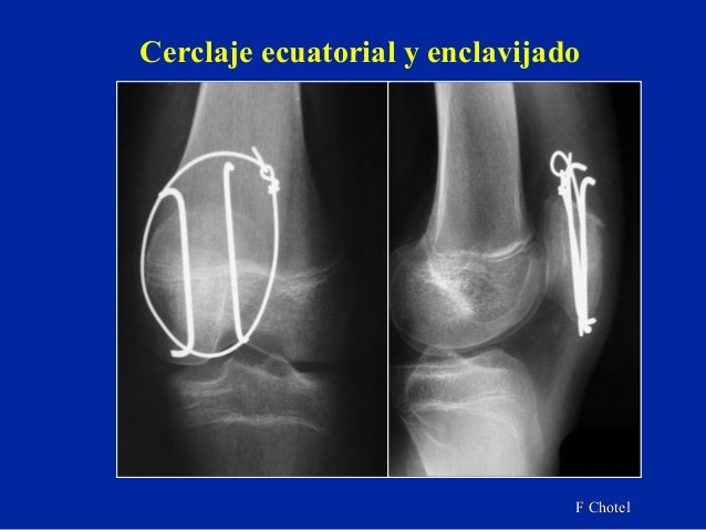 04 fracturas de la rotula