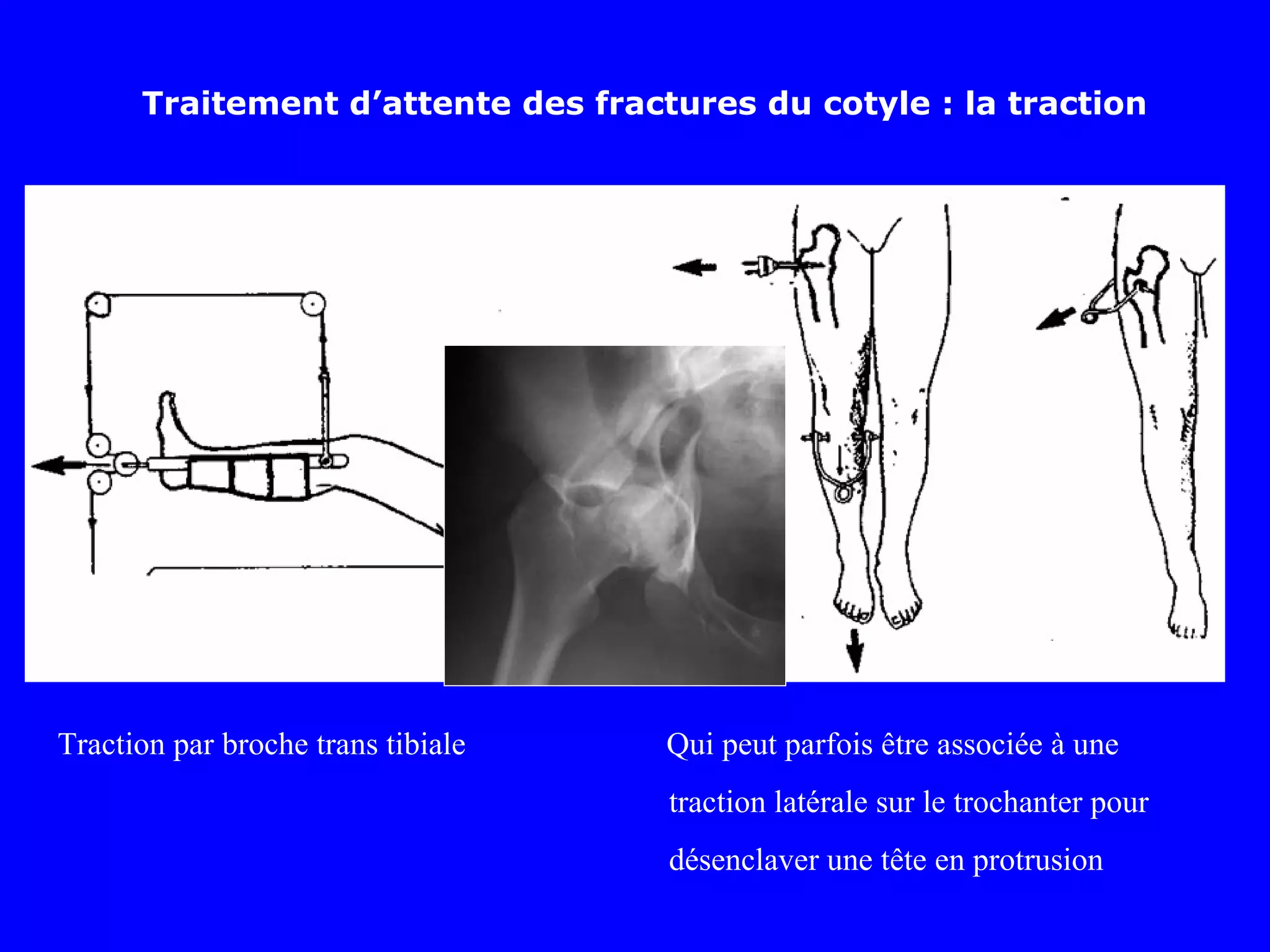 04 fractures du cotyle (1) | PPT | Death, Injury, or Military Conflict ...