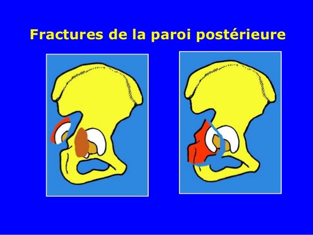 04 fractures du cotyle (1)