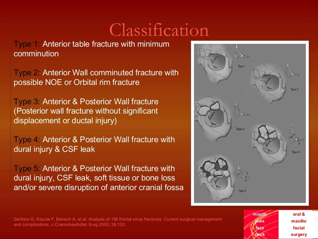 04 frontal sinus FRACTURE