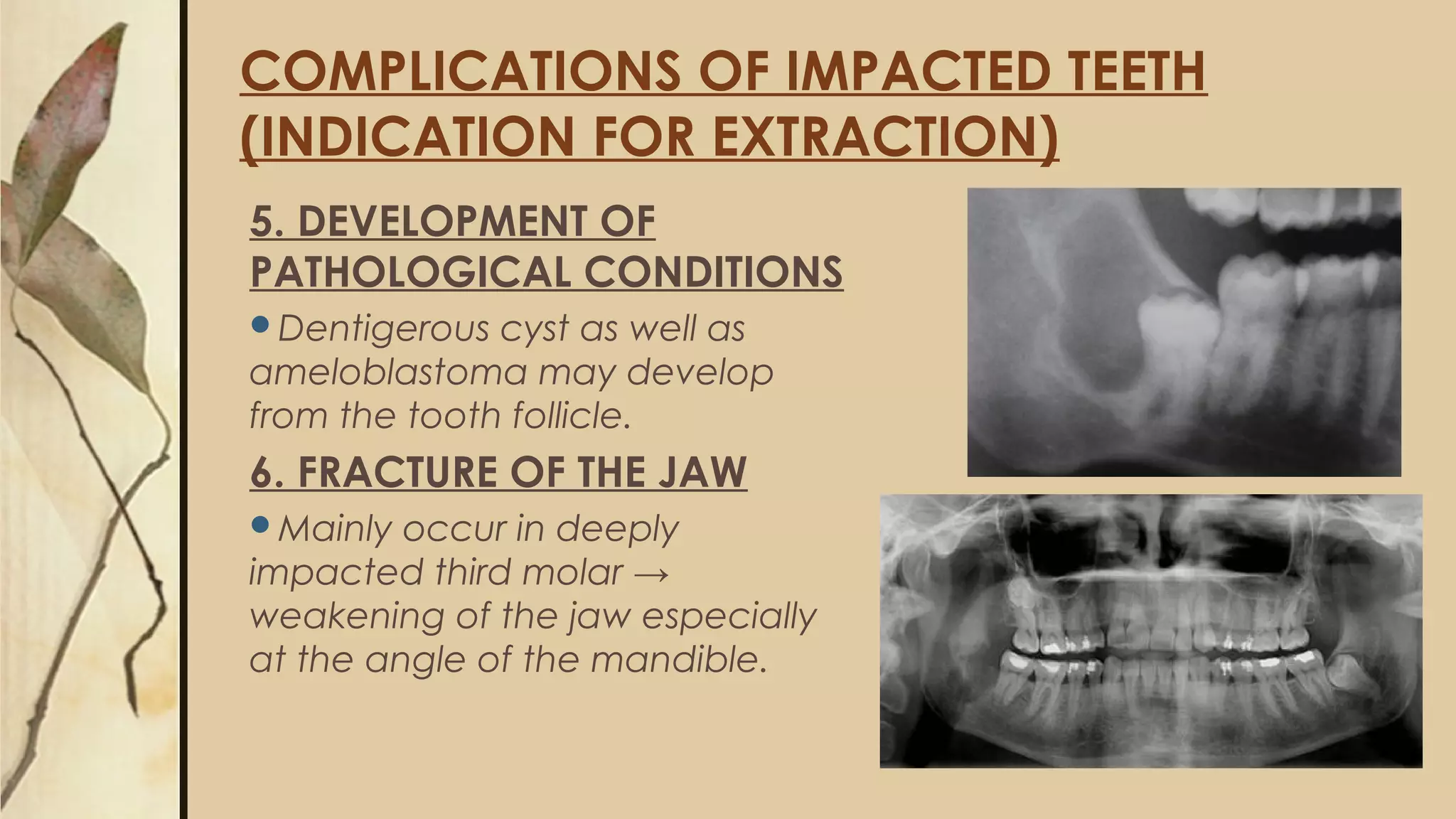 Surgical removal of Impacted teeth | PPT
