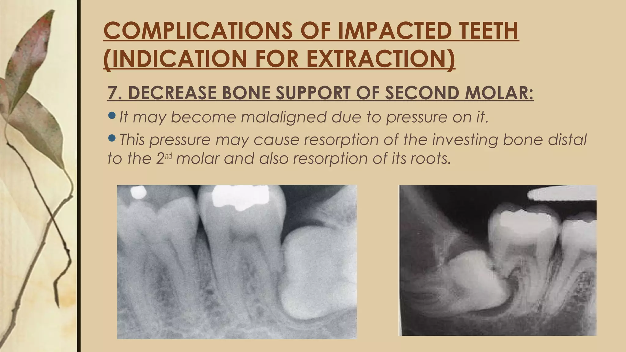 Surgical removal of Impacted teeth | PPT