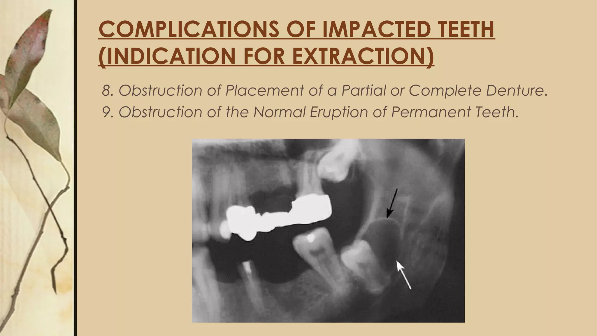 Surgical removal of Impacted teeth | PPT