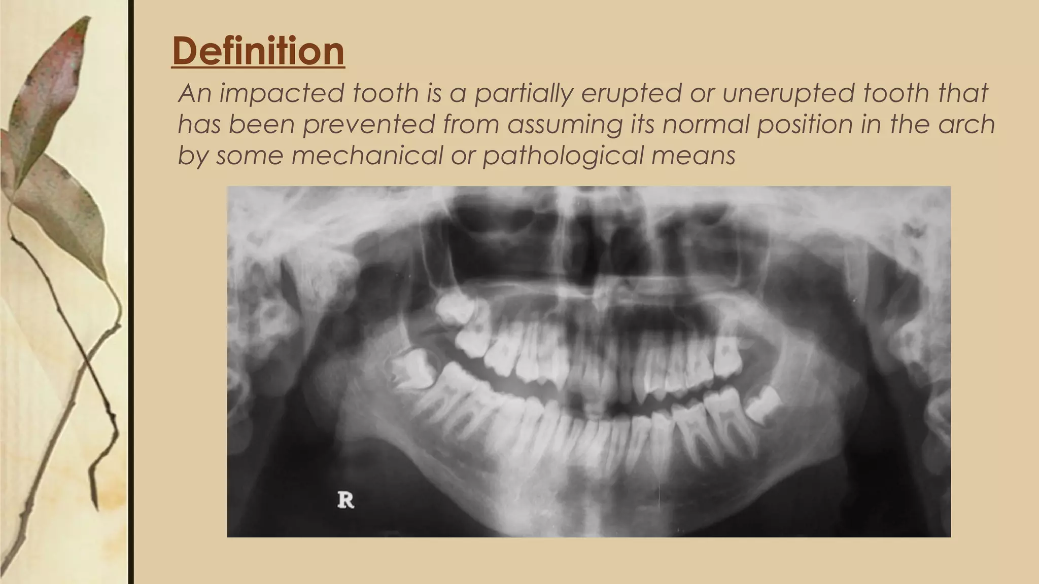 Surgical removal of Impacted teeth | PPT