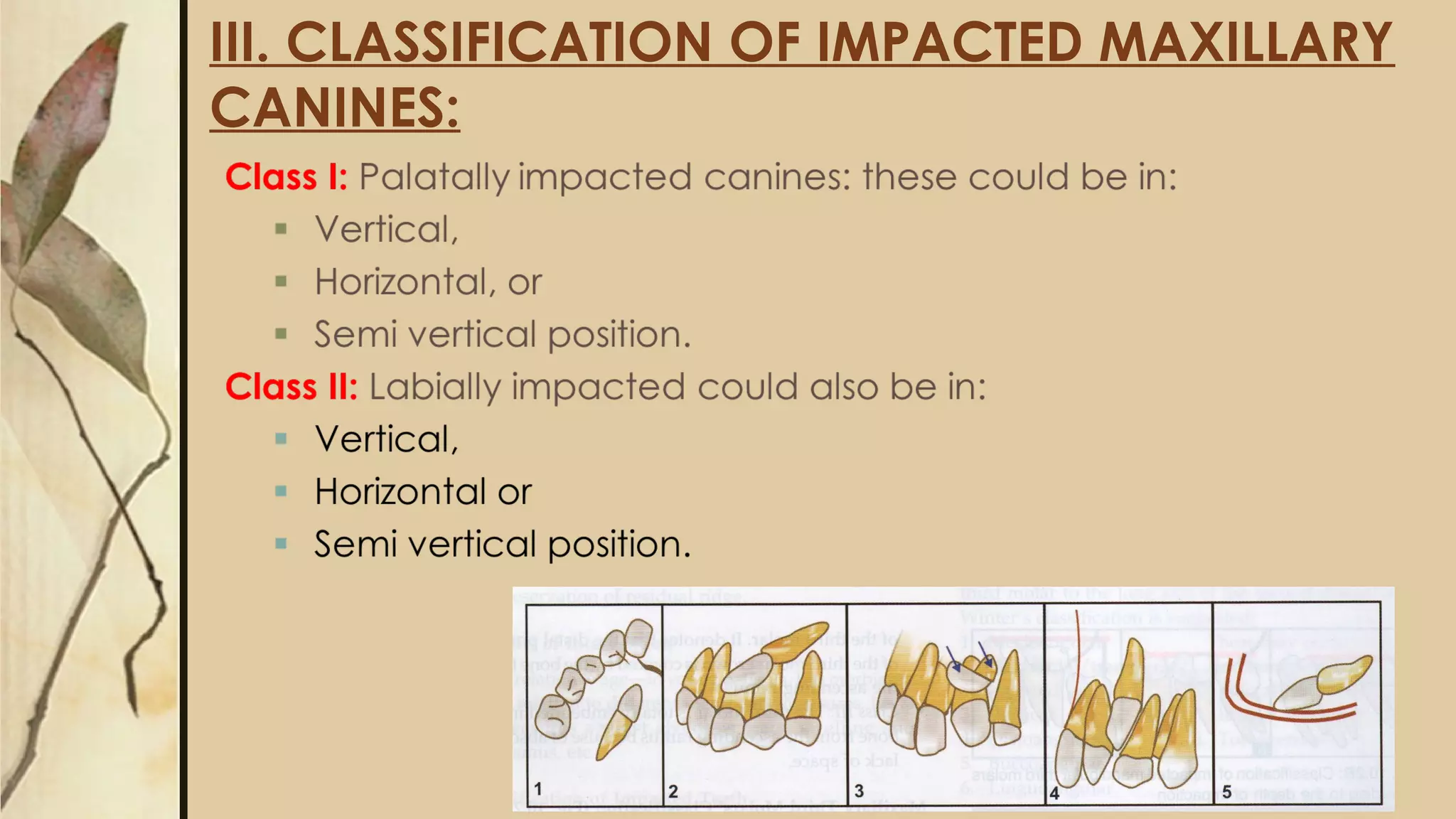 Surgical removal of Impacted teeth | PPT