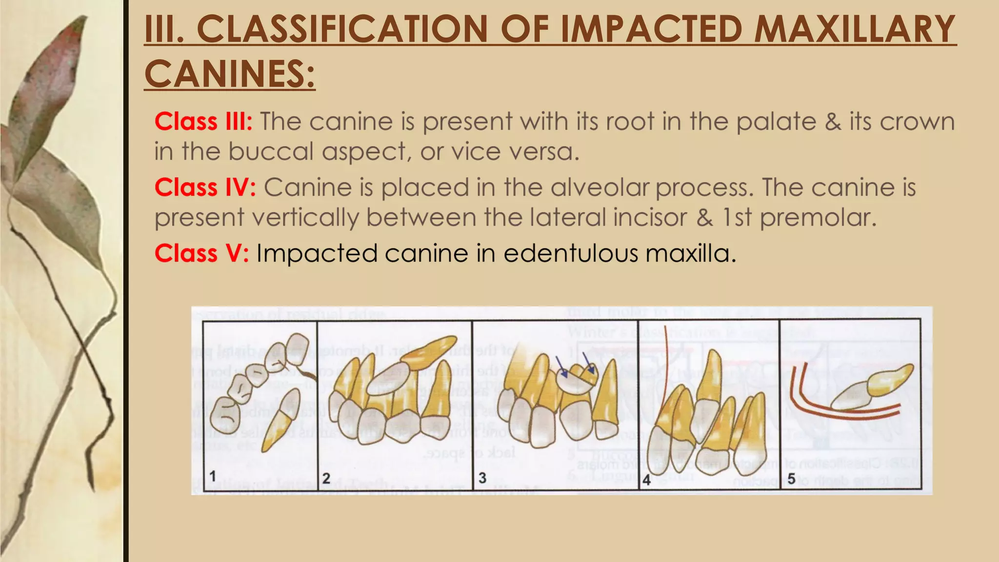 Surgical removal of Impacted teeth | PPT