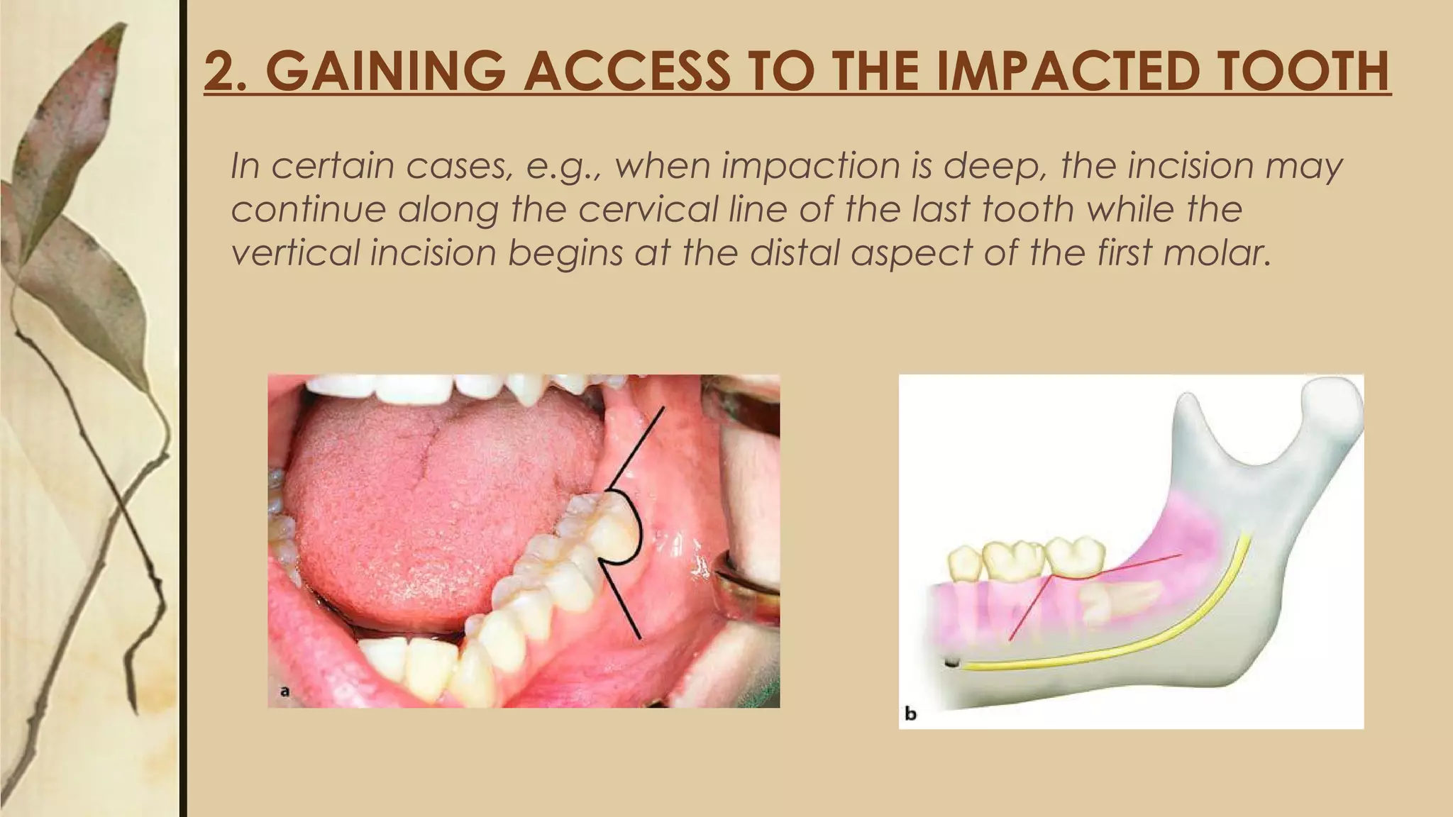 Surgical removal of Impacted teeth | PPT