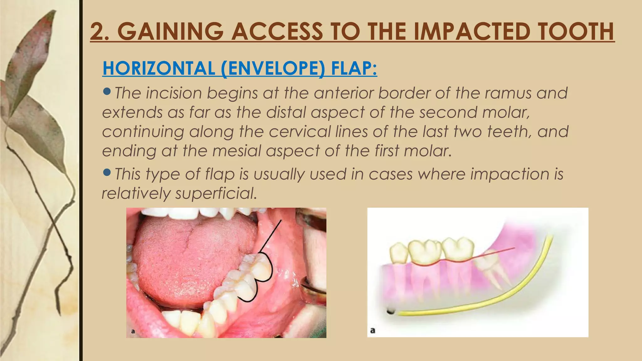 Surgical removal of Impacted teeth | PPT