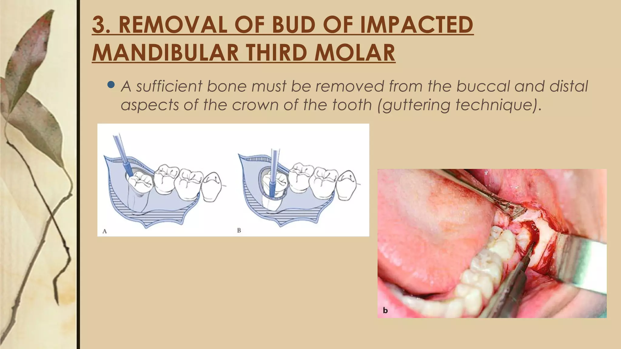 Surgical removal of Impacted teeth | PPT