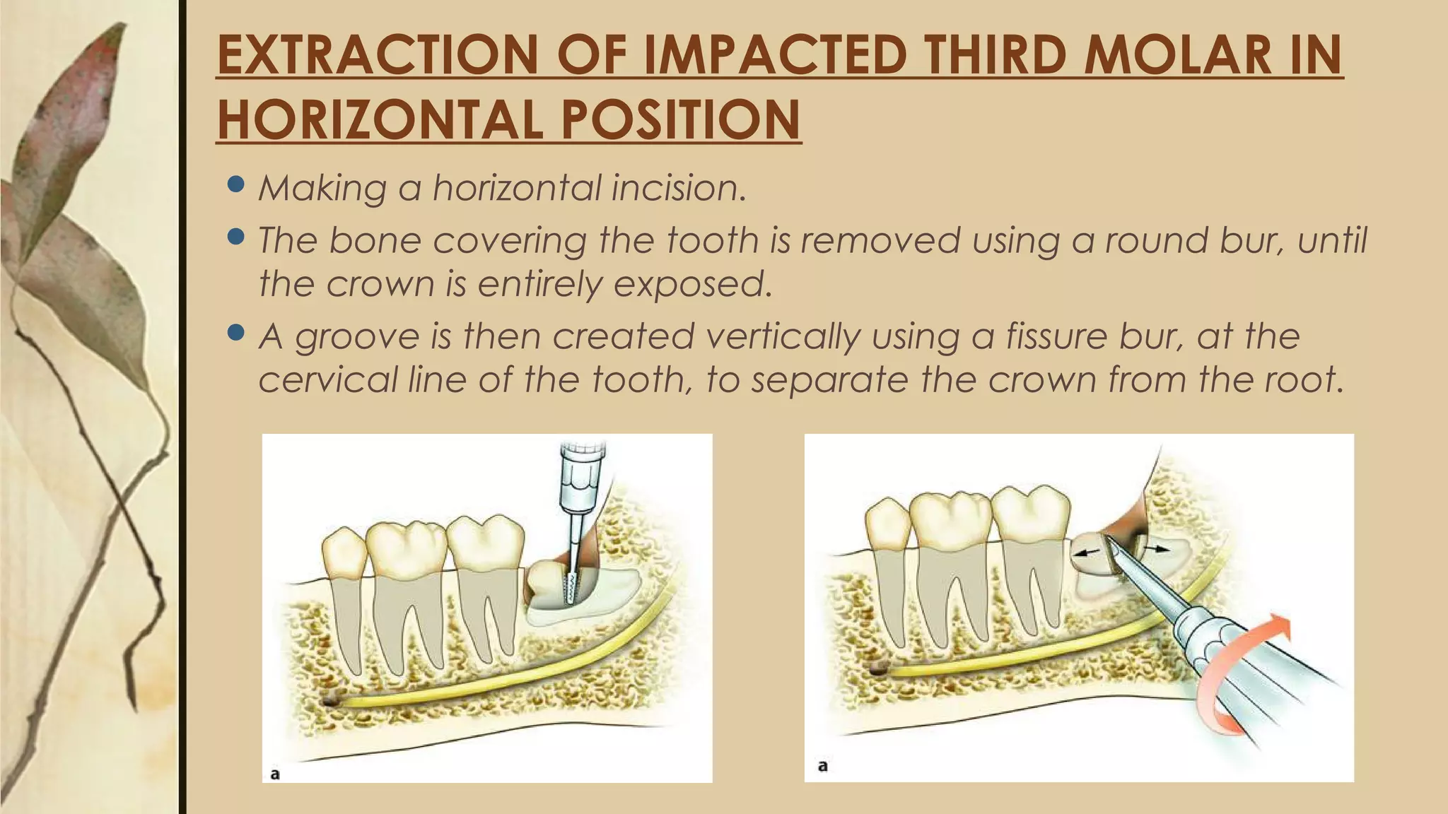 Surgical removal of Impacted teeth | PPT