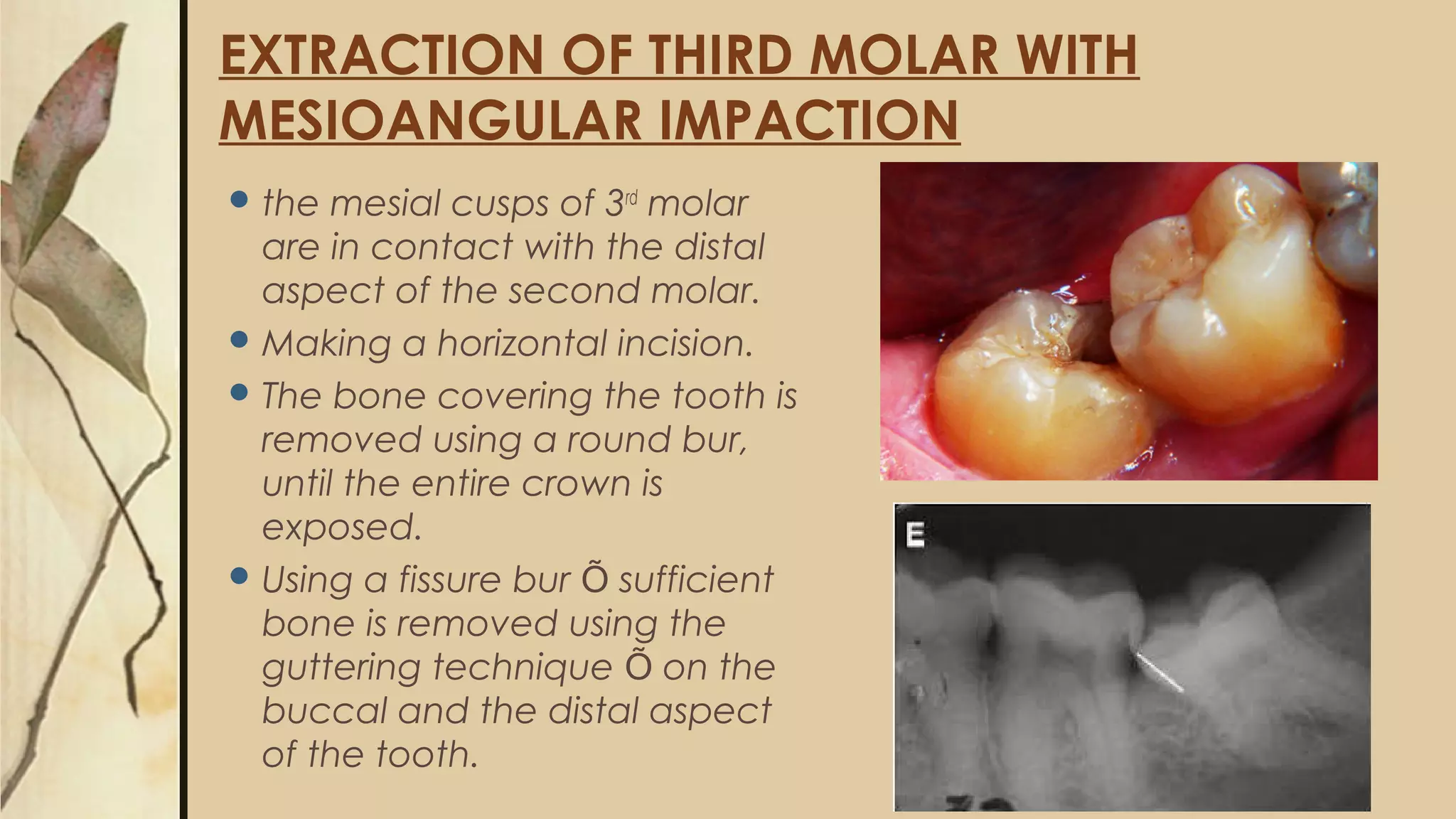 Surgical removal of Impacted teeth | PPT