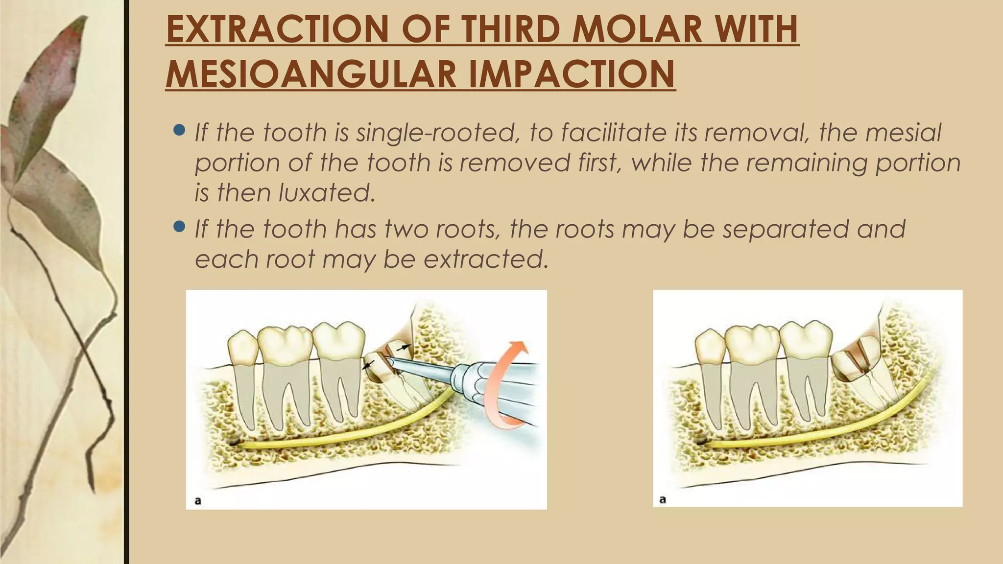 Surgical removal of Impacted teeth | PPT