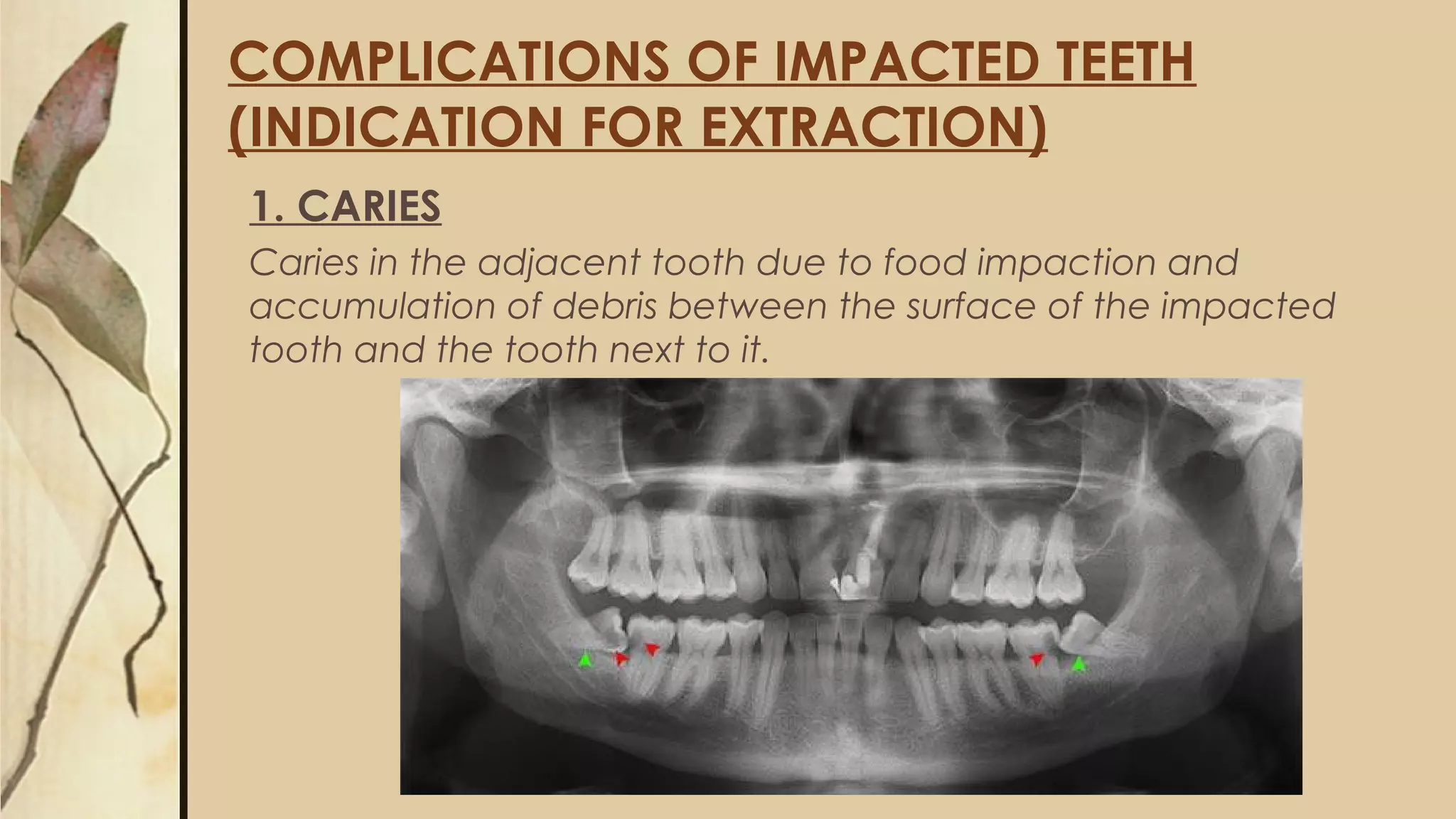 Surgical removal of Impacted teeth | PPT