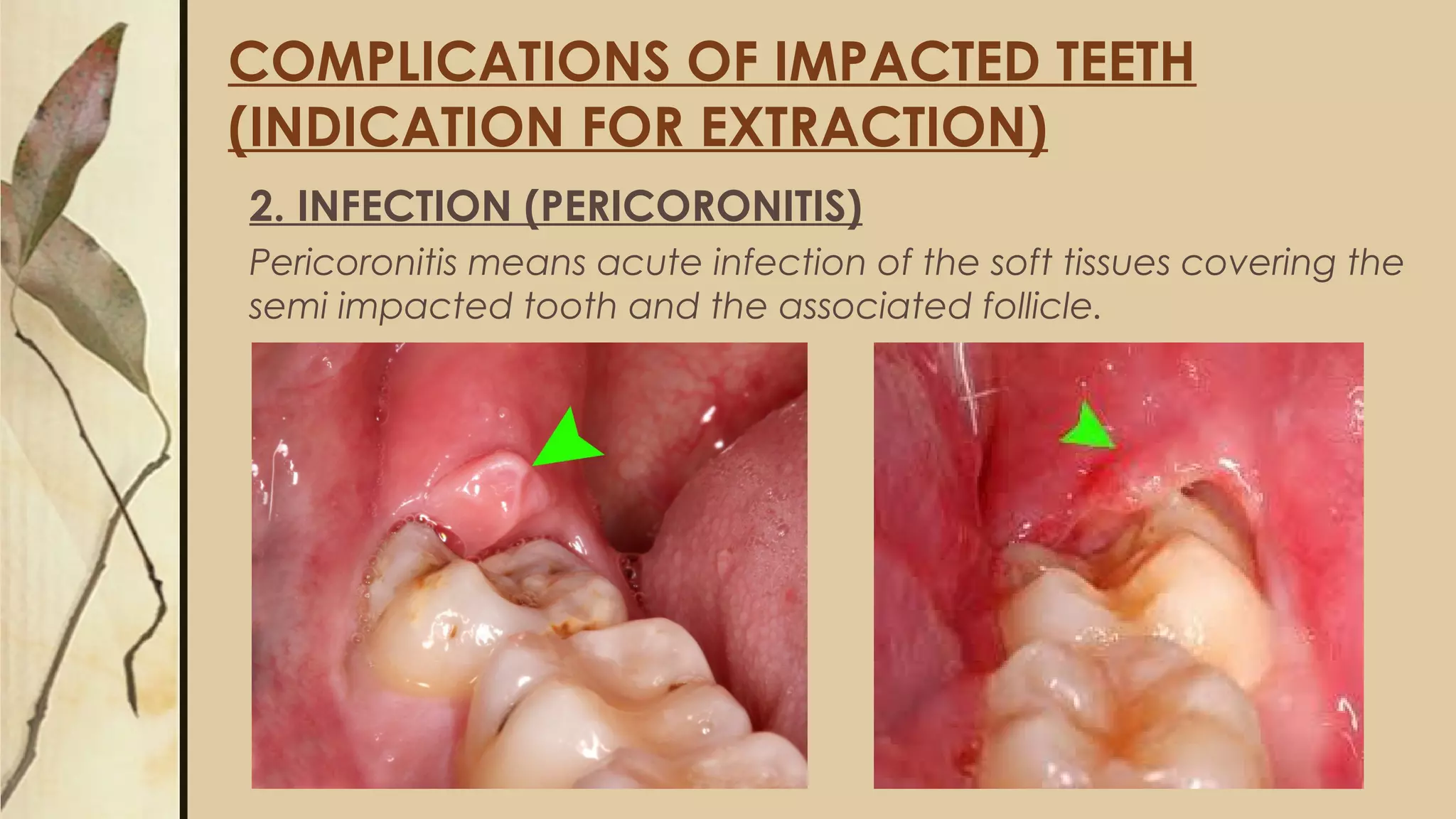 Surgical removal of Impacted teeth | PPT