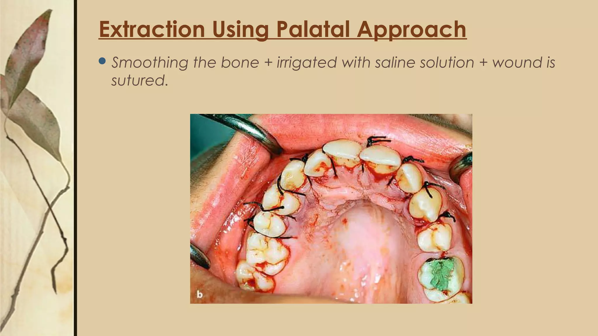 Surgical removal of Impacted teeth | PPT