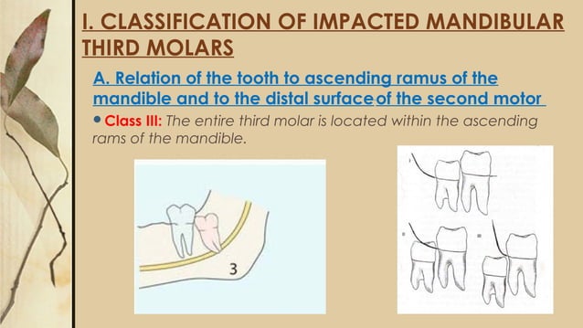 Surgical removal of Impacted teeth | PPT