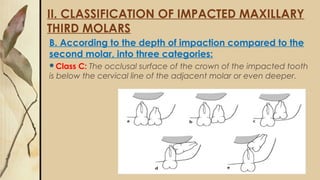 Surgical removal of Impacted teeth | PPT