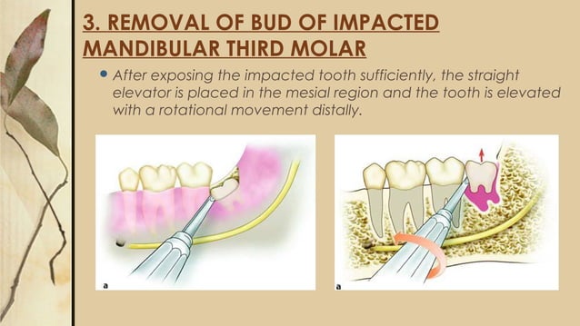 Surgical removal of Impacted teeth | PPT