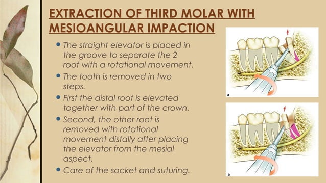 Surgical removal of Impacted teeth | PPT