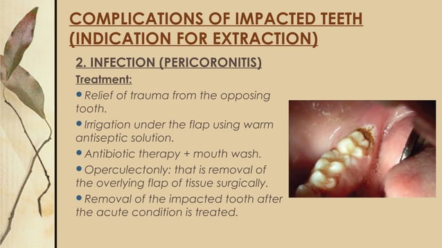 Surgical removal of Impacted teeth | PPT