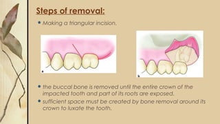 Surgical removal of Impacted teeth | PPT