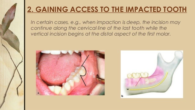 Surgical removal of Impacted teeth