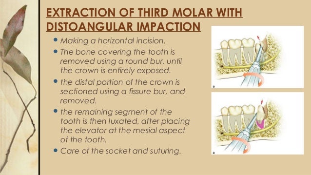 Surgical removal of Impacted teeth
