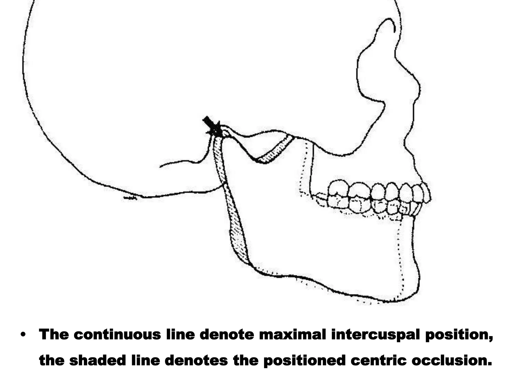 04- Occlusion in prosthodontics- Concepts of occlusion.ppt