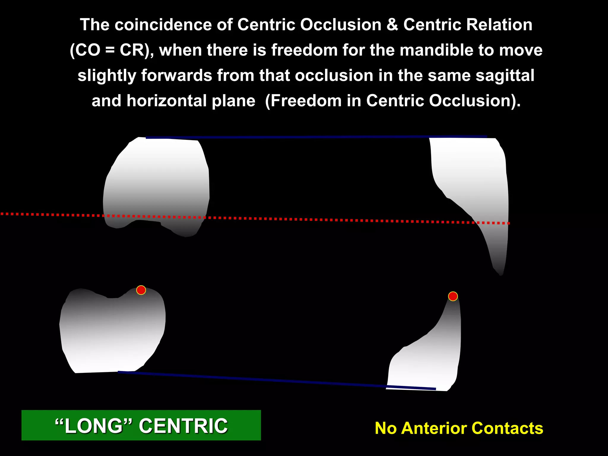 04- Occlusion in prosthodontics- Concepts of occlusion.ppt