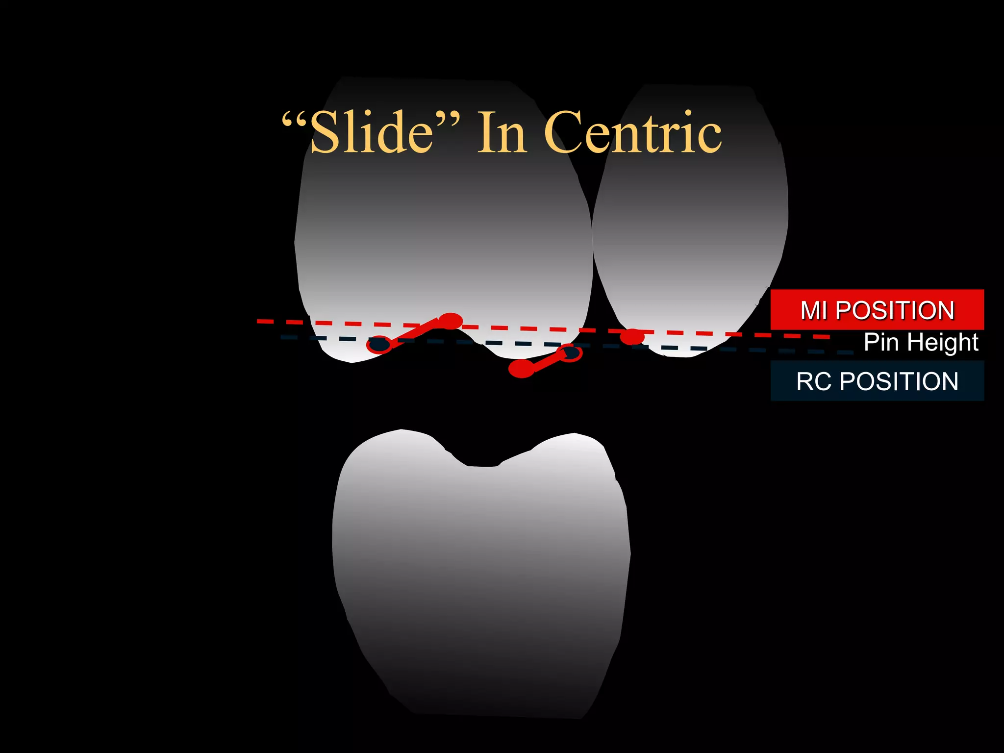 04- Occlusion in prosthodontics- Concepts of occlusion.ppt