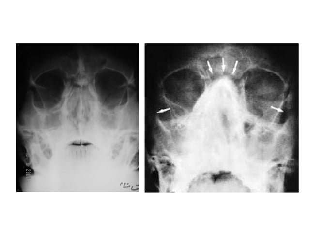 04 radiology in maxillofacial trauma.ppt. new presentation | PPT