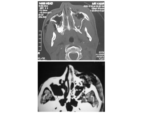 04 radiology in maxillofacial trauma.ppt. new presentation | PPT
