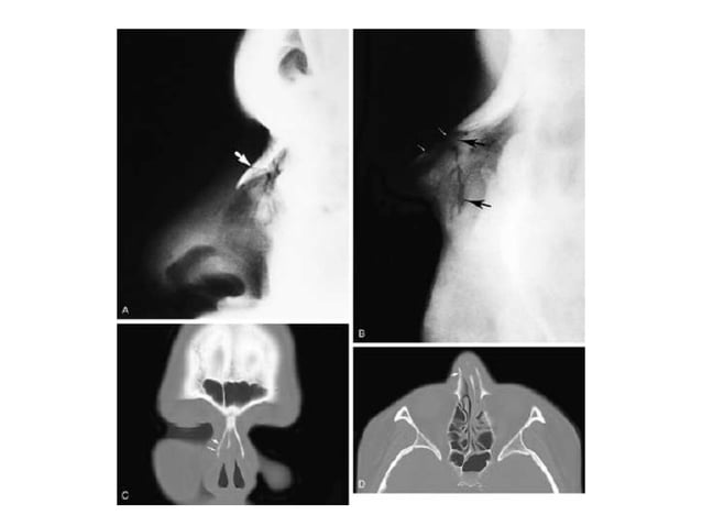 04 radiology in maxillofacial trauma.ppt. new presentation | PPT