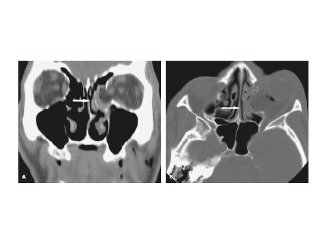 04 radiology in maxillofacial trauma.ppt. new presentation | PPT
