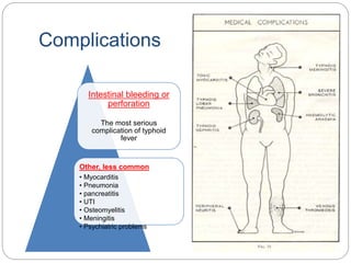 Typhoid_Fever.ppt