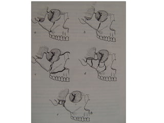 04 zmc fracture | PPT