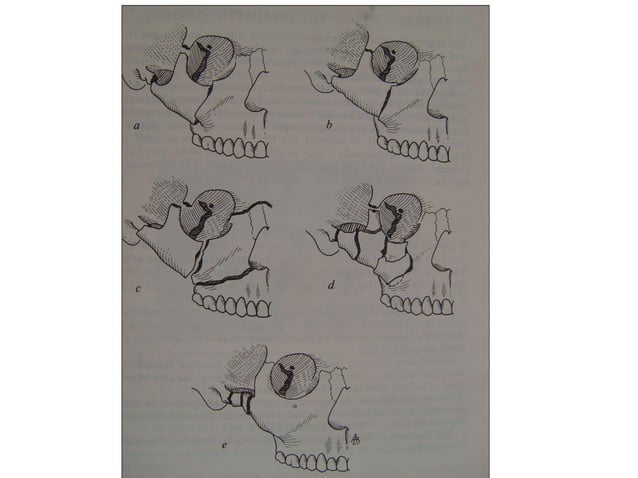 04 zmc fracture | PPT