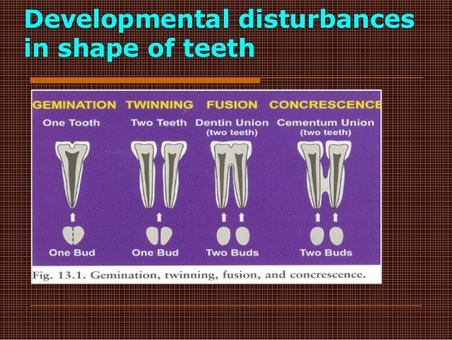 Developmental disturbances of teeth
