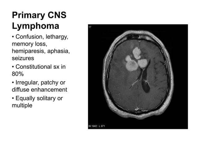 Ring Enhancing Lesion in HIV Positive Patient | PPT