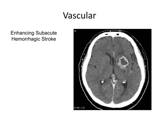 Ring Enhancing Lesion in HIV Positive Patient | PPT