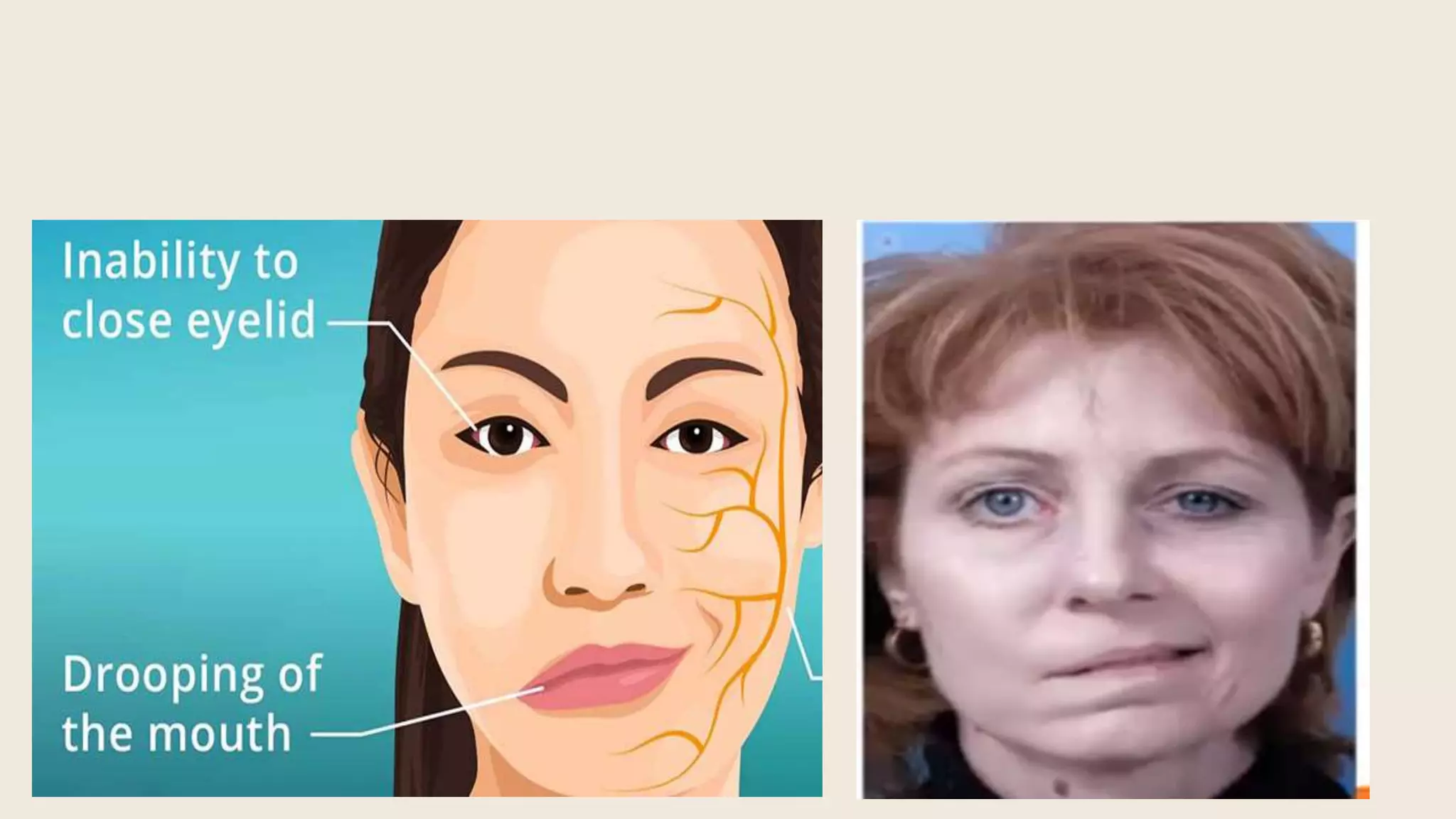 Bell's Palsy | PPTX