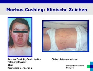 04.09 Hypophysenerkrankungen. hypophysiärer Morbus Cushing